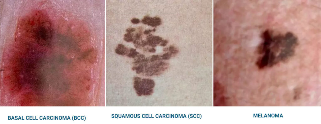 Types of Skin Cancers - The Lakes Family Medical Centre