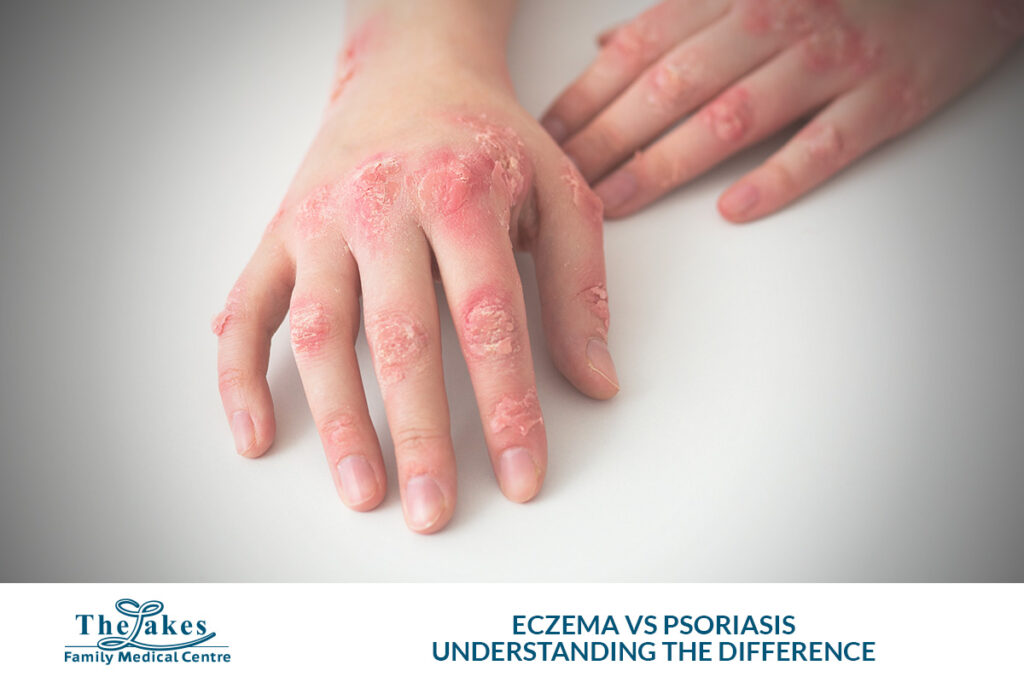 Eczema vs Psoriasis: Understanding the Difference - The Lakes Family ...